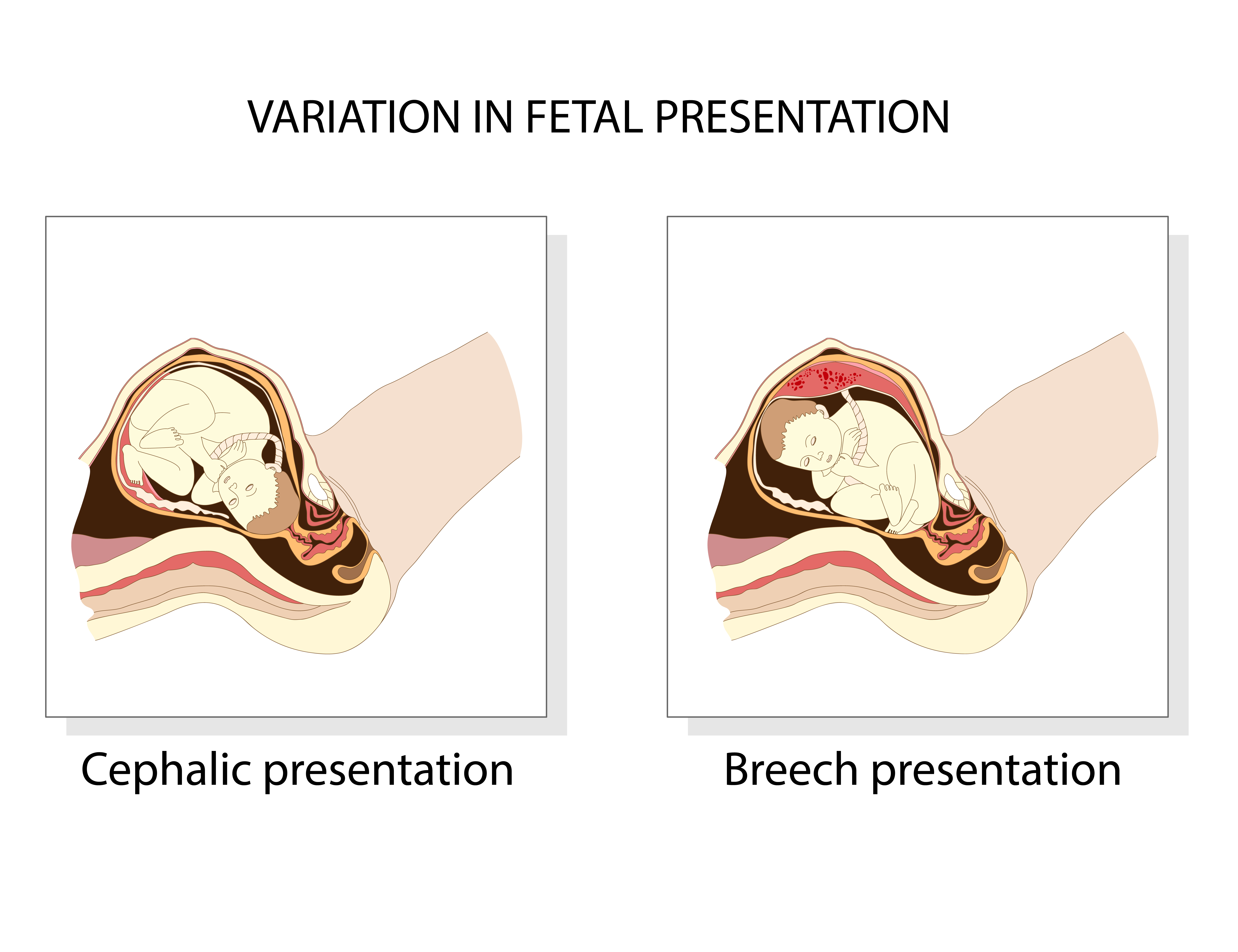 Fetal position that is abnormal (breech), is often caused by pelvic ...