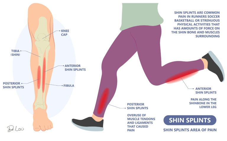 shin splints - Jacobs Chiropractic Acupuncture
