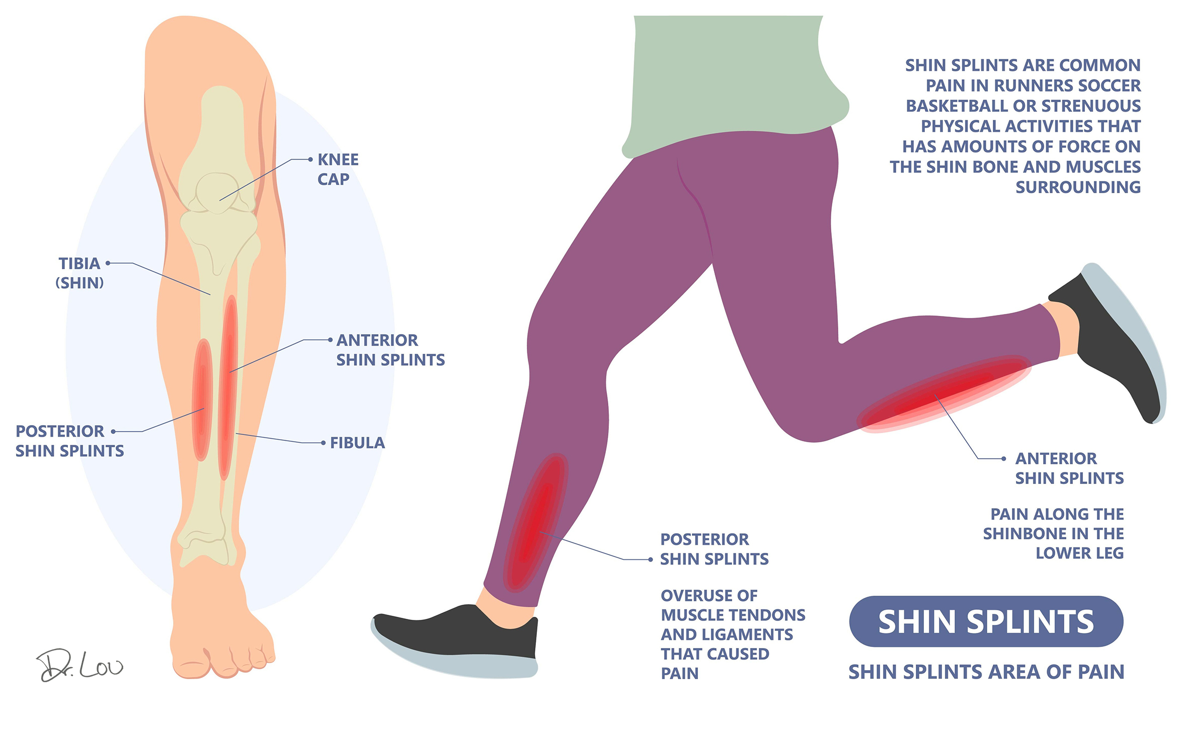 Shin Splints What Are They How Can I Fix Them Jacobs Chiropractic 